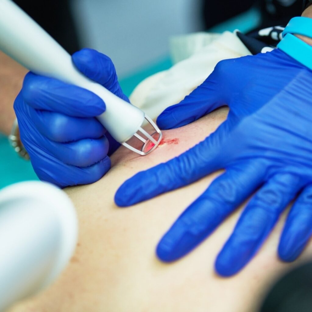 Scar Revision - Hamdan Aesthetic